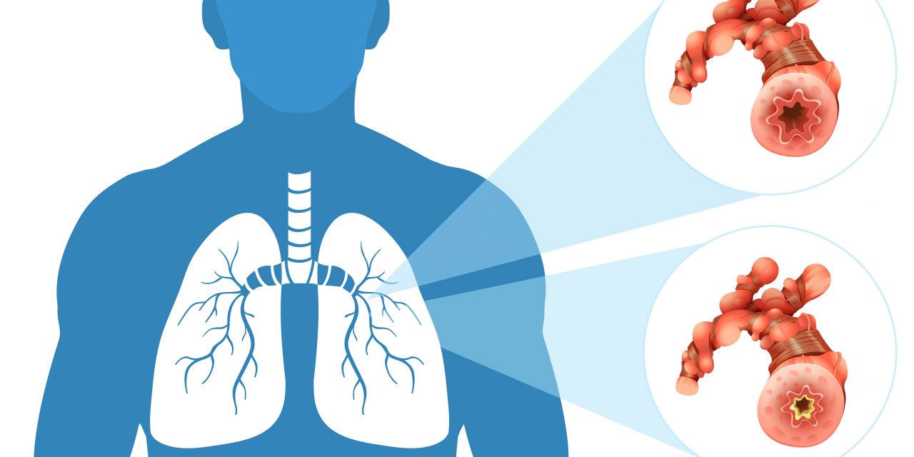 Conheça os sintomas de tuberculose - Kompa Saúde